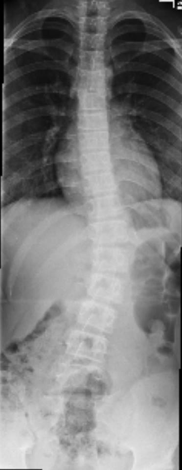 LA Scoliosis Brace | Single Low Curve