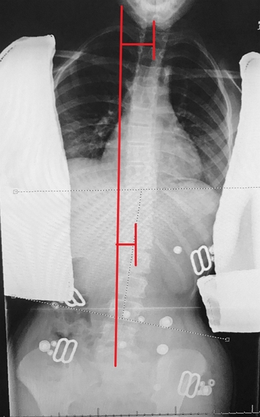 Scoliosis Decompensation and CSL Displacement - LA Brace Center