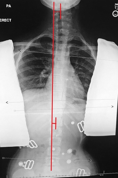 Scoliosis Decompensation and CSL Displacement - LA Brace Center